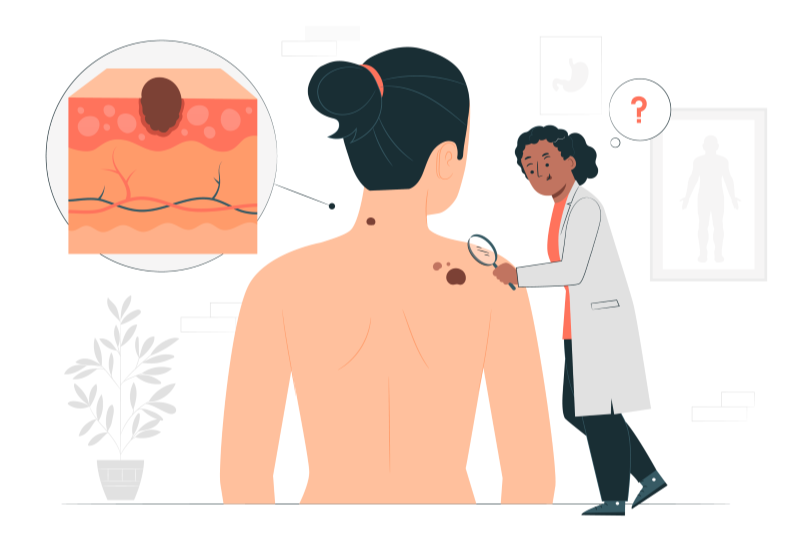 Melanoma: Causes, Symptoms, Stages, and Treatment Options