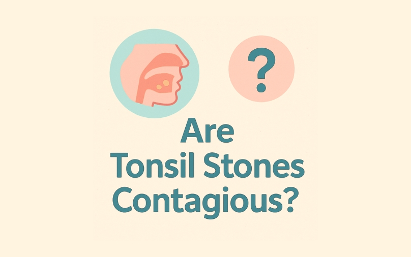Are Tonsil Stones Contagious? What to Know