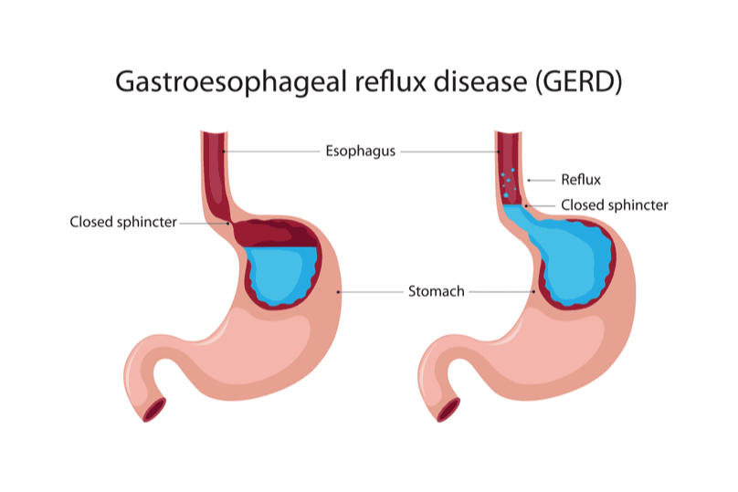 Comprehensive Overview of GERD: From Symptoms to Cure