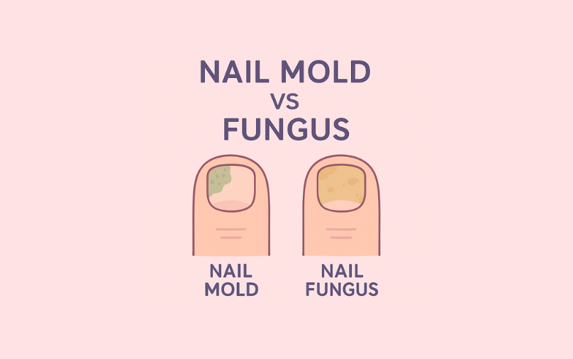 Nail Mold vs Fungus: Identify and Treat the Right Issue