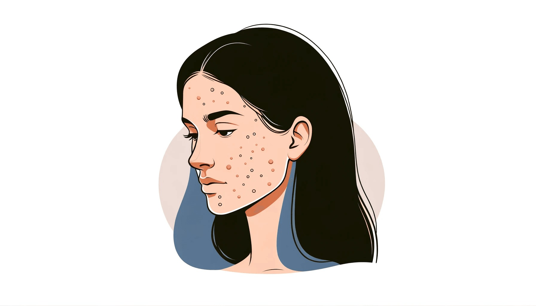 Fungal Acne Explained: Causes, Symptoms and Care Strategies